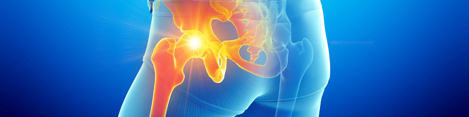 » Artrosis de cadera y su tratamiento | FisioClinics